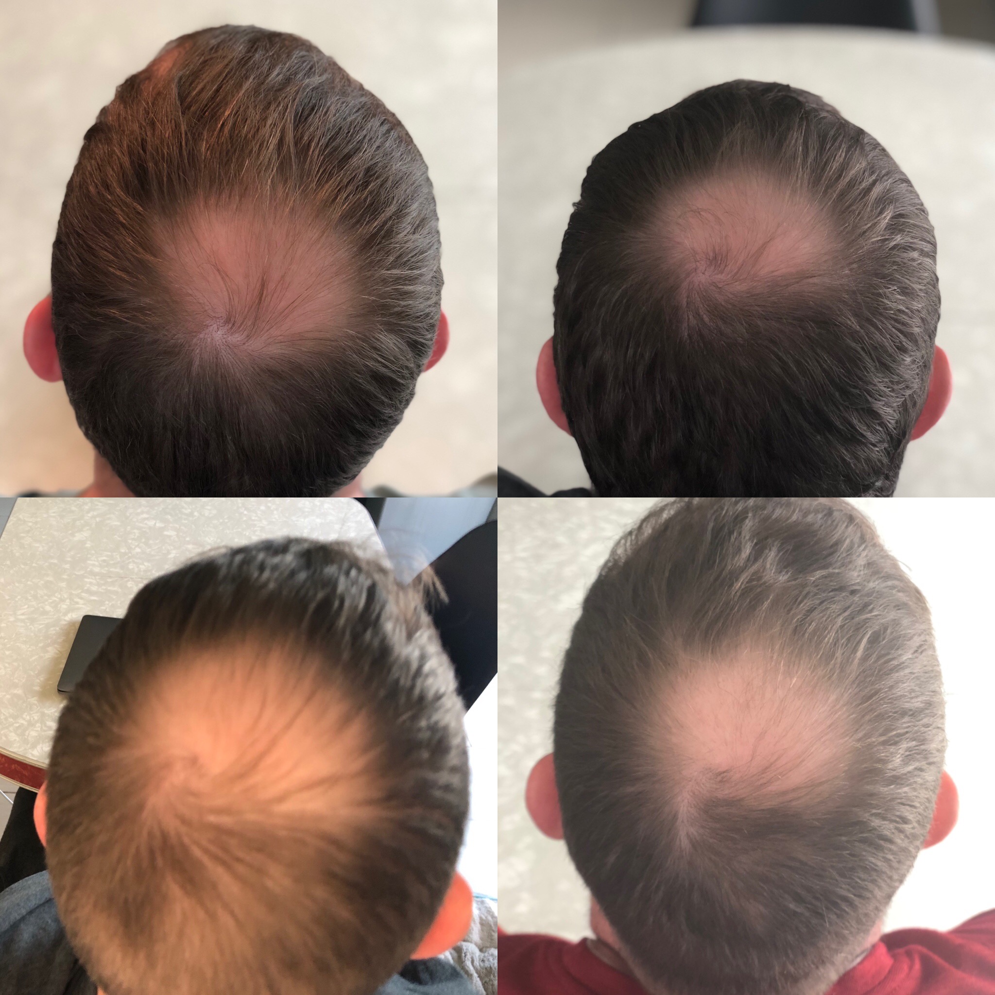 Hairmax LaserBand 82 hair growth laser light device review - The Gadgeteer